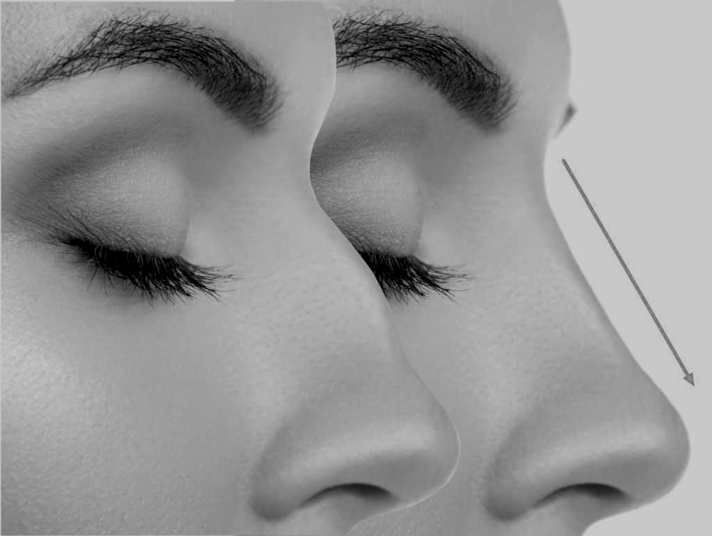 Nariz / Rinoplastia - Dr. Luis Cesar Valencia Garcia